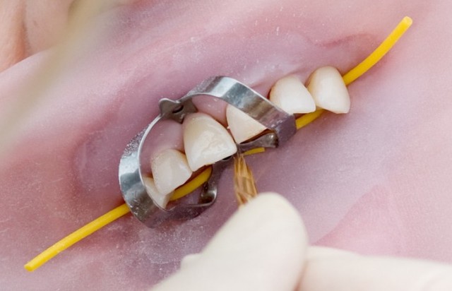 Rubber Dental Dams What They Are And Why Dentists Use Them Oral Answers