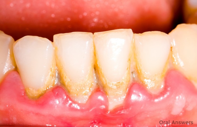 Seven Reasons Your Gums Are Enlarged | Oral Answers