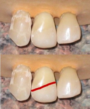 How a Chipped Tooth Can Be Repaired With a White Composite Filling ...