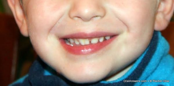 Double Teeth – Gemination and Fusion | Oral Answers