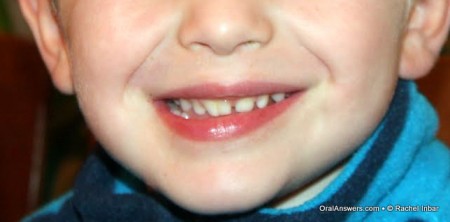 Double Teeth – Gemination and Fusion | Oral Answers