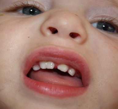 Double Teeth – Gemination and Fusion | Oral Answers