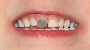 Dark Tooth: Why Your Child Has a Discolored Tooth | Oral Answers