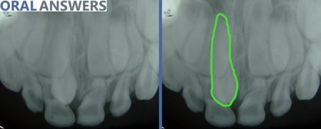 Extra Tooth: Mesiodens and Other Supernumerary Teeth | Oral Answers