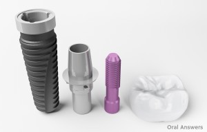 Parts of a Dental Implant: The Implant, Abutment, and Crown | Oral Answers