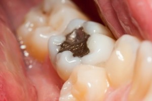 Why Your Tooth Is Sensitive After A Filling | Oral Answers