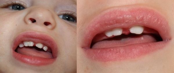Double Tooth Photos | Oral Answers