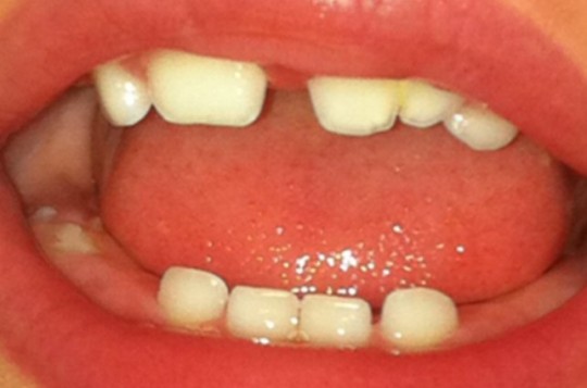 Double Tooth Photos | Oral Answers
