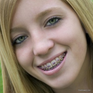 60 Photos of Teenagers with Braces | Oral Answers