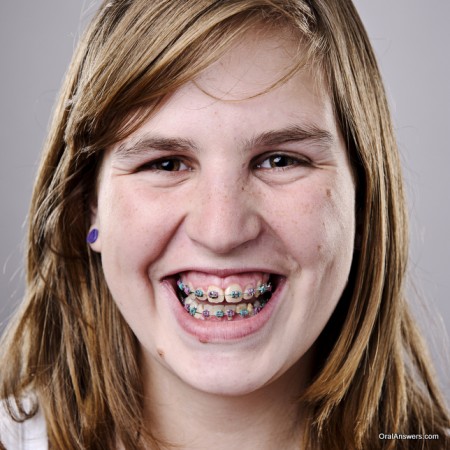60 Photos of Teenagers with Braces | Oral Answers