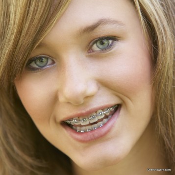 60 Photos of Teenagers with Braces | Oral Answers
